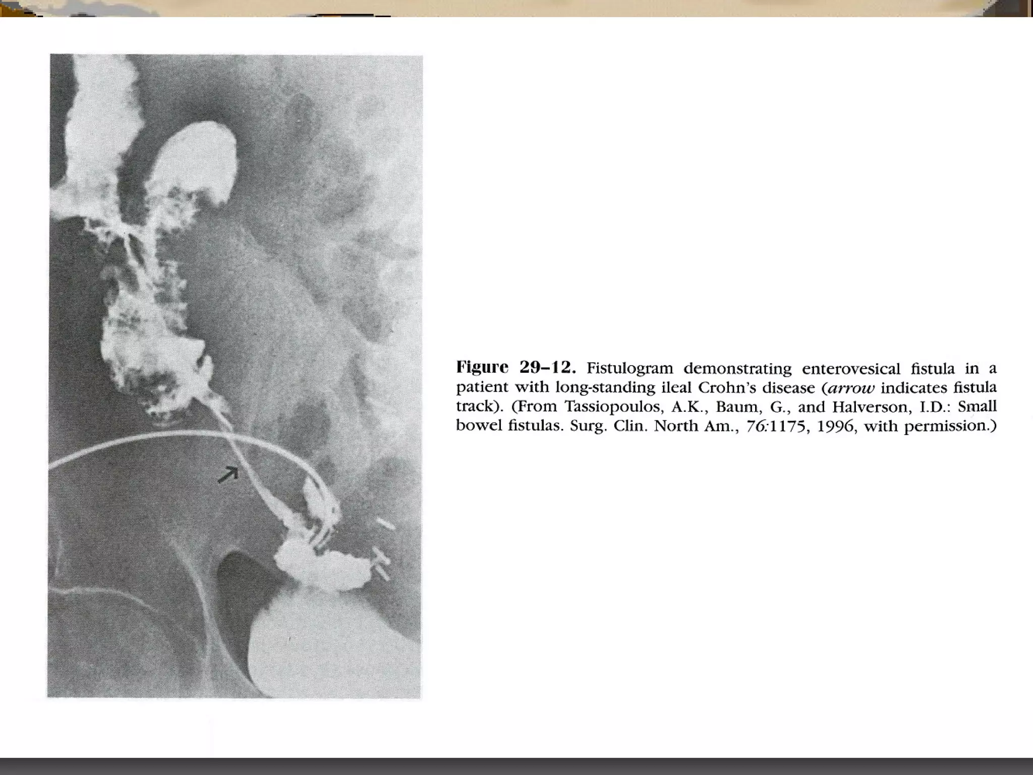 internal fistula of bowel | PPT