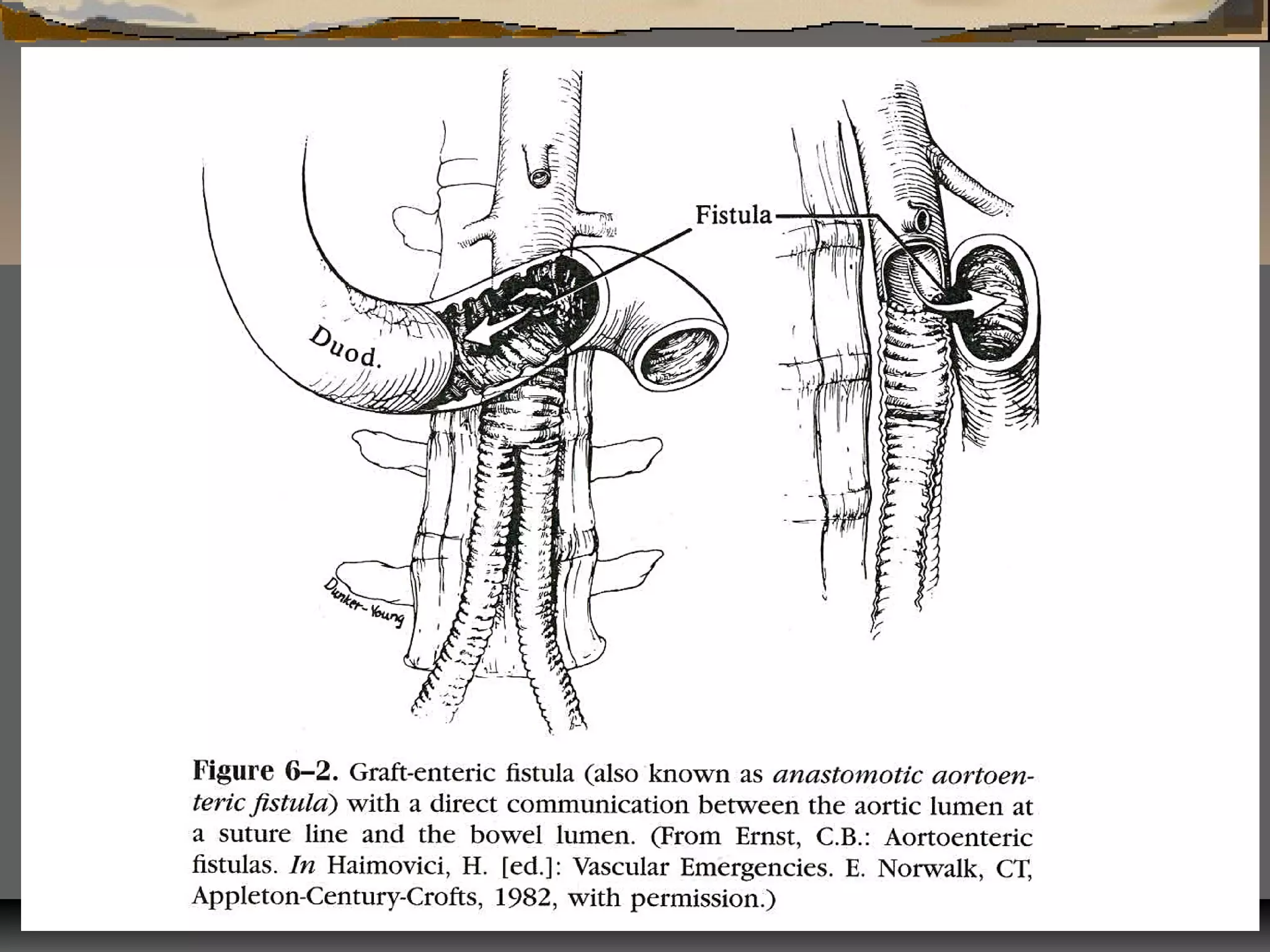 internal fistula of bowel | PPT