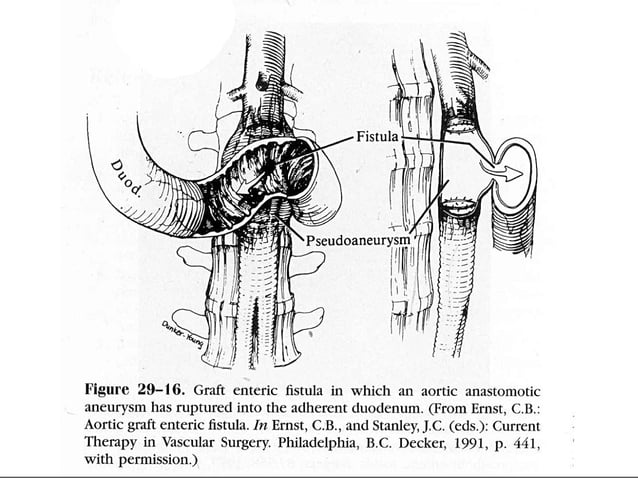 internal fistula of bowel | PPT