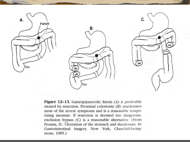 internal fistula of bowel | PPT