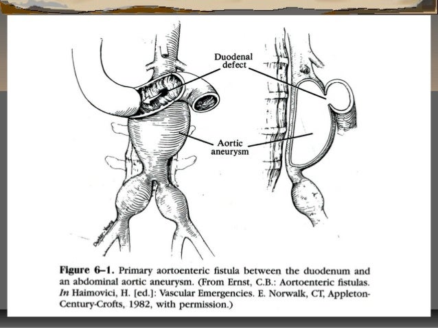 internal fistula of bowel