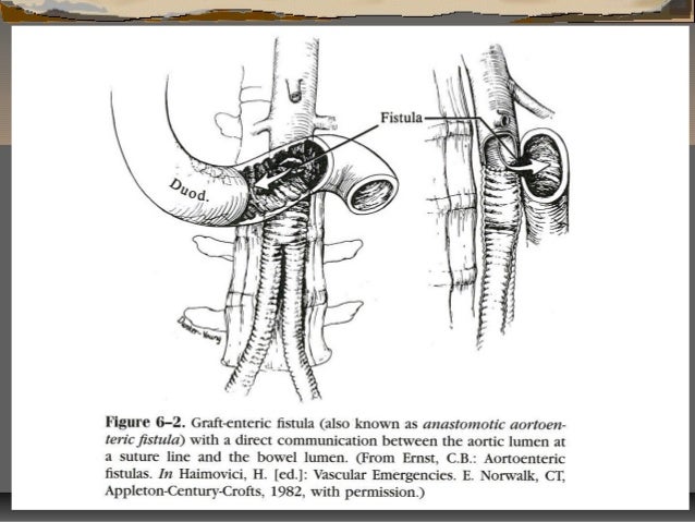 internal fistula of bowel