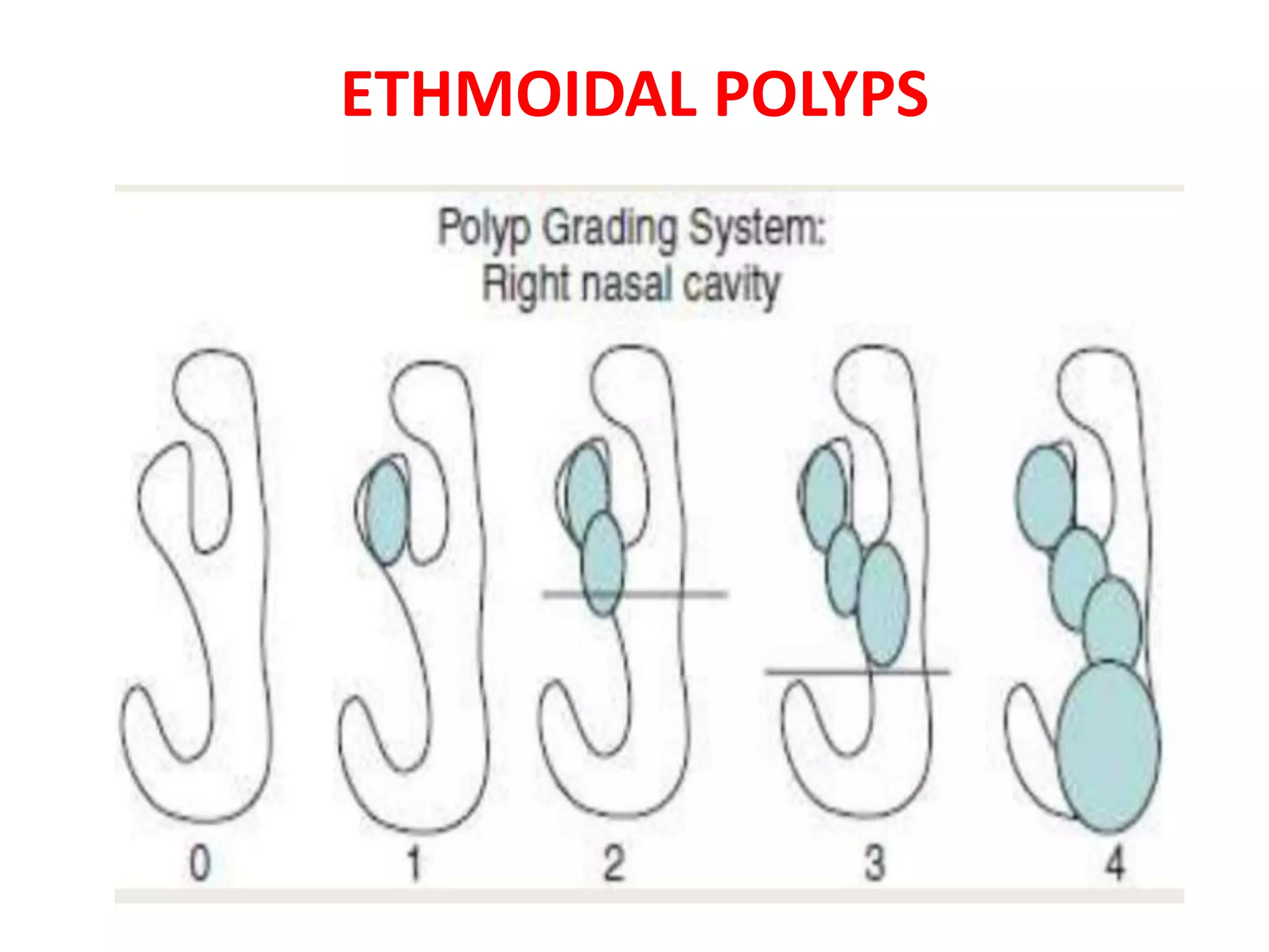 NASAL POLYPS | PPTX