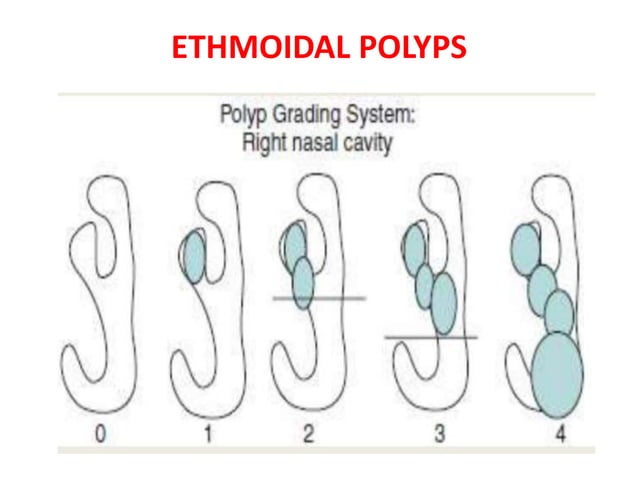 NASAL POLYPS | PPTX | Ear, Nose and Throat Conditions | Diseases and ...