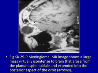 29 orbital masses not involving the optic nerve | PPT