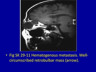 29 orbital masses not involving the optic nerve | PPT