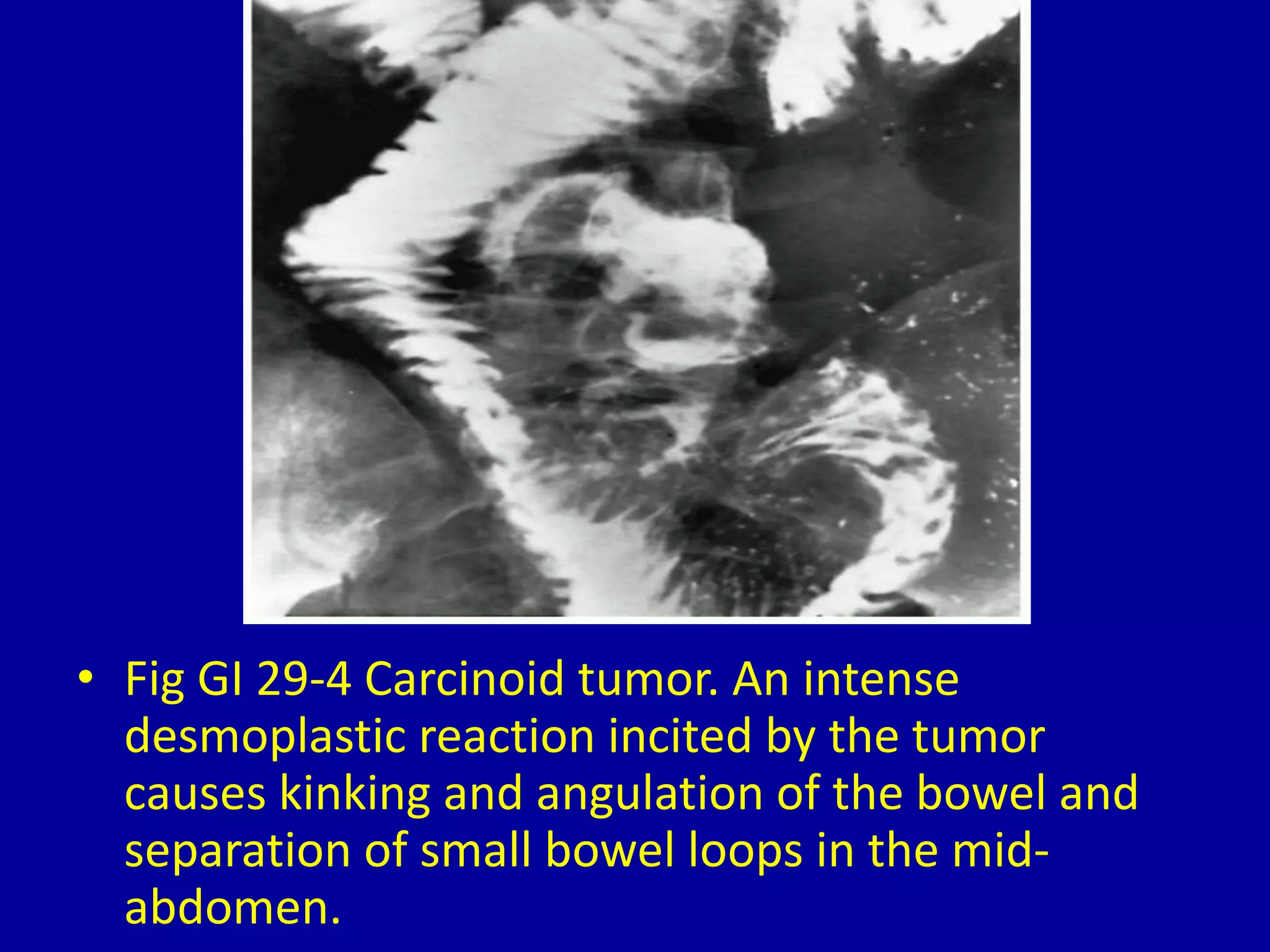 29 separation of small bowel loops | PPTX | Medical Health
