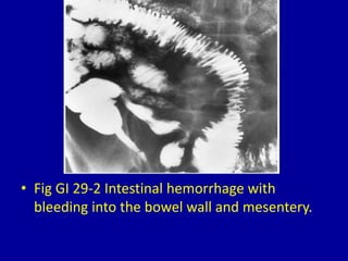 29 separation of small bowel loops | PPTX | Medical Health