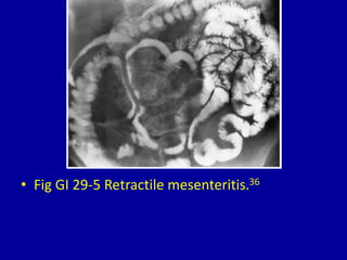 29 separation of small bowel loops | PPTX