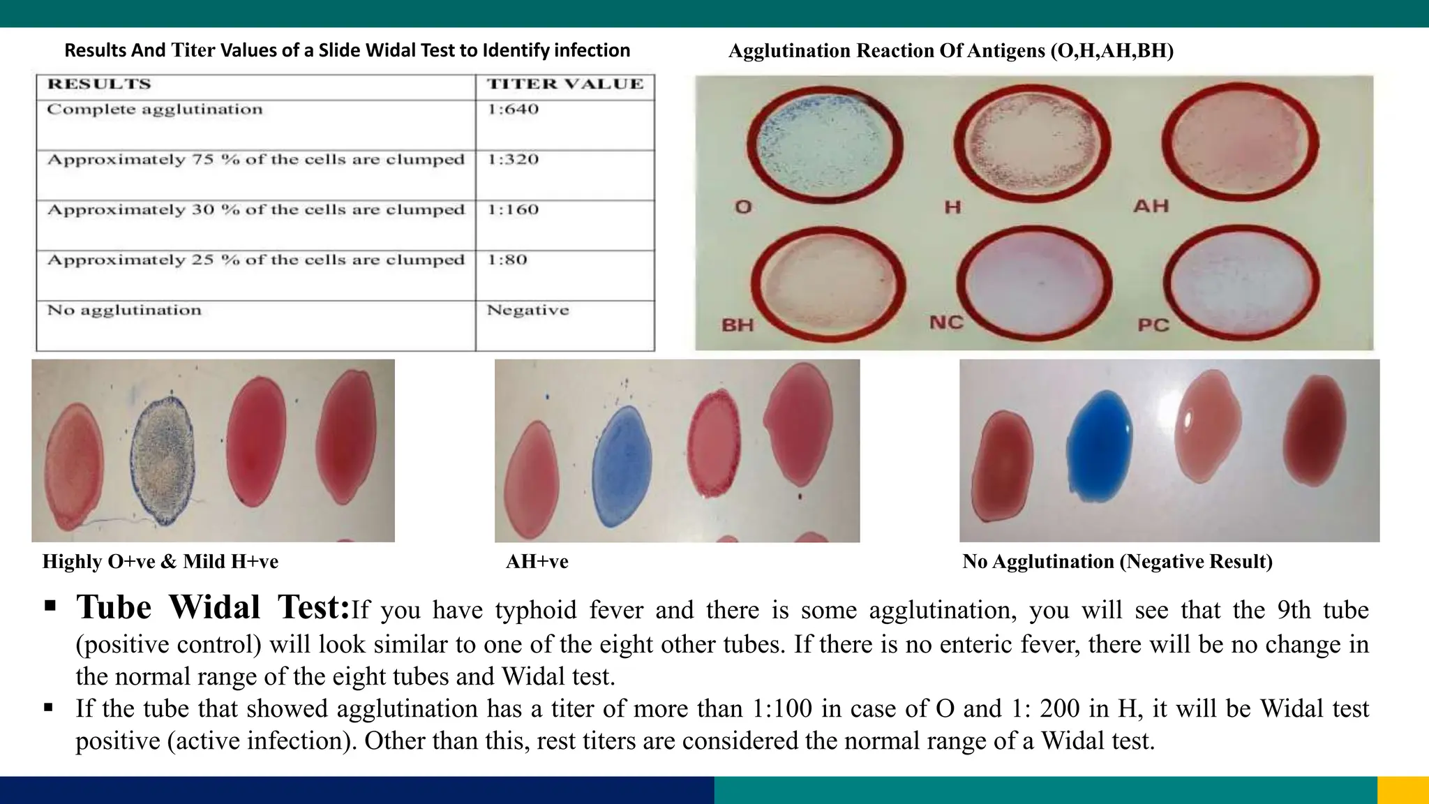 Widal Agglutination Test: A rapid serological diagnosis of typhoid ...