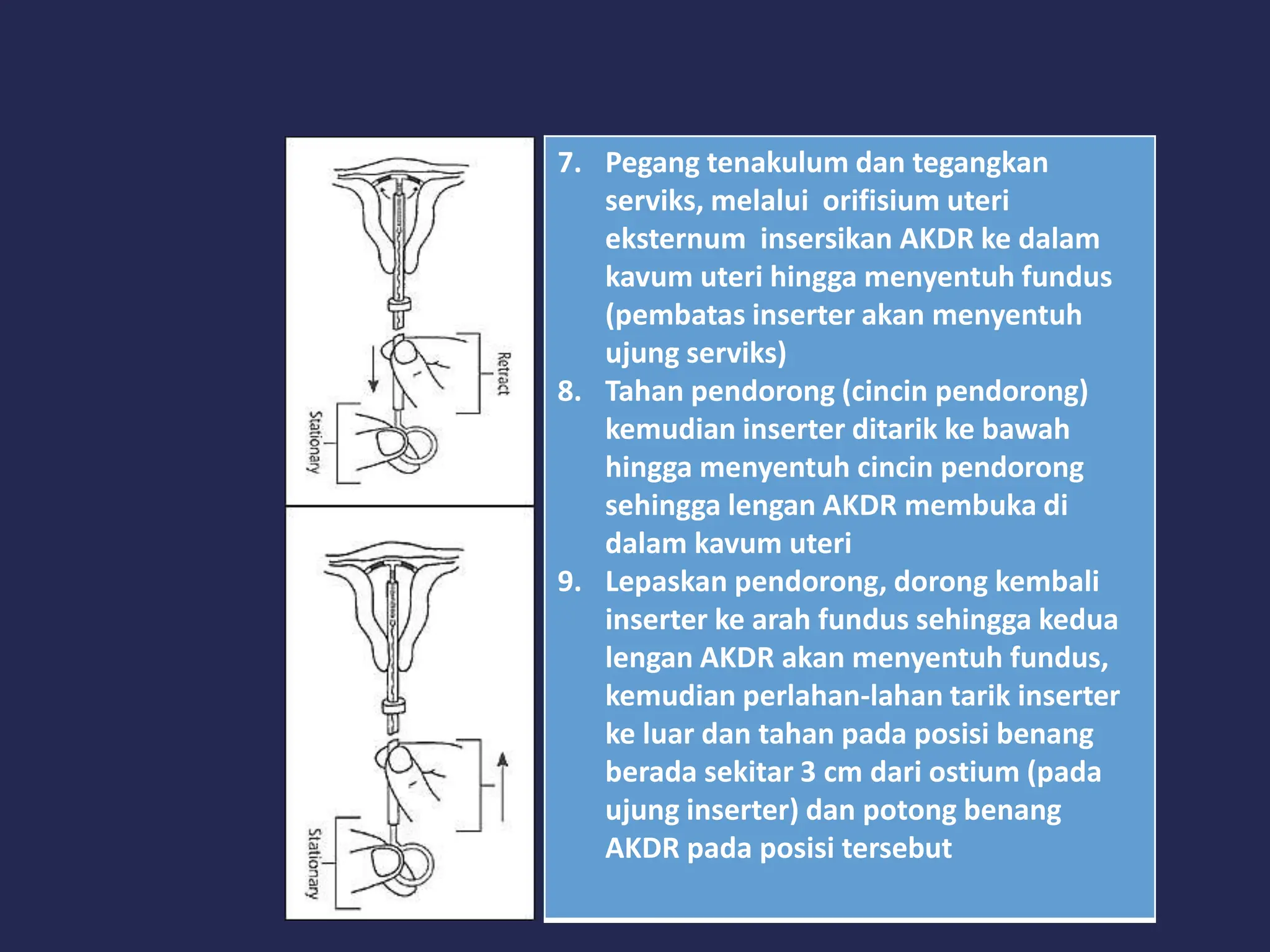 2a. Alat Kontrasepsi Dalam Rahim AKDR.pptx