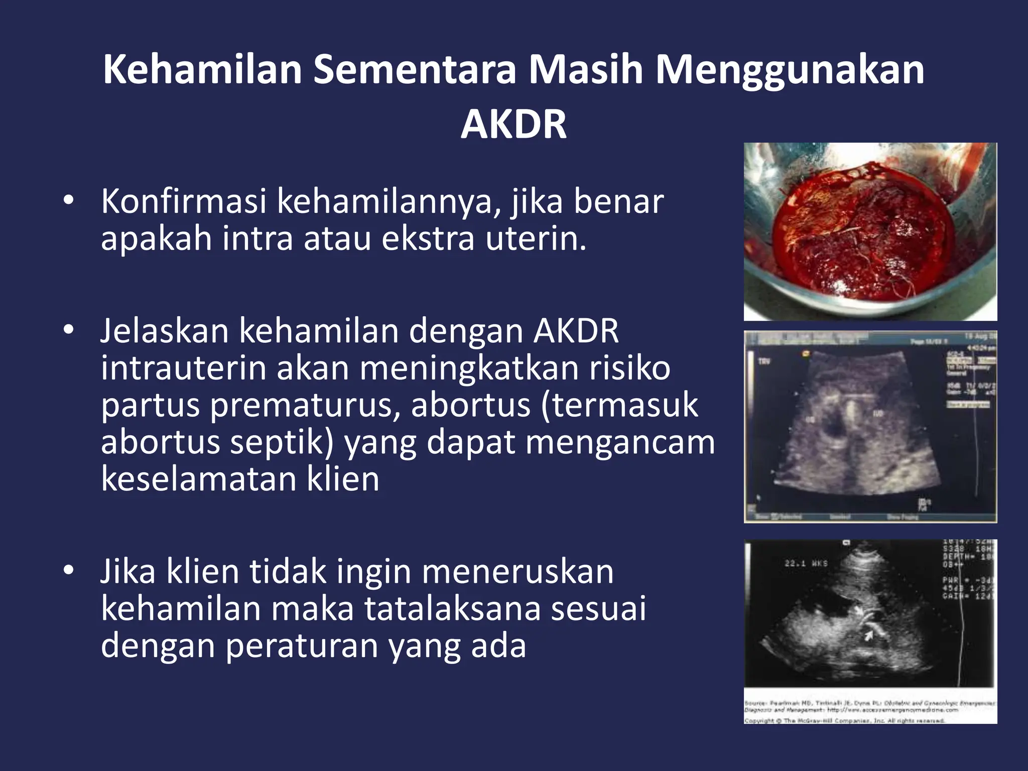2a. Alat Kontrasepsi Dalam Rahim AKDR.pptx