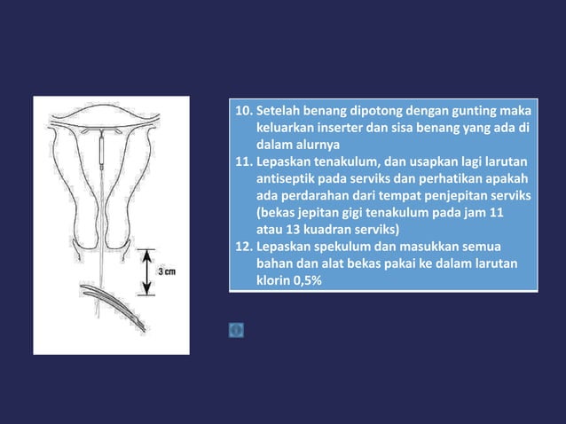 2a. Alat Kontrasepsi Dalam Rahim AKDR.pptx