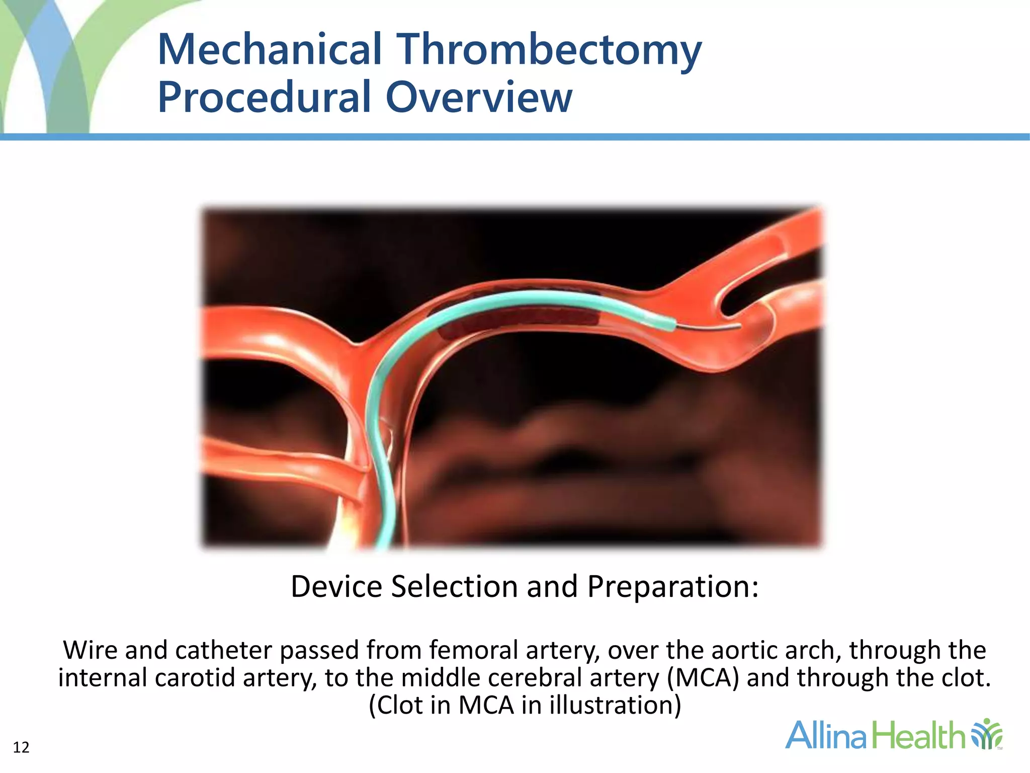 Neurointerventional Treatment of Acute Stroke in 2015 at Abbott ...