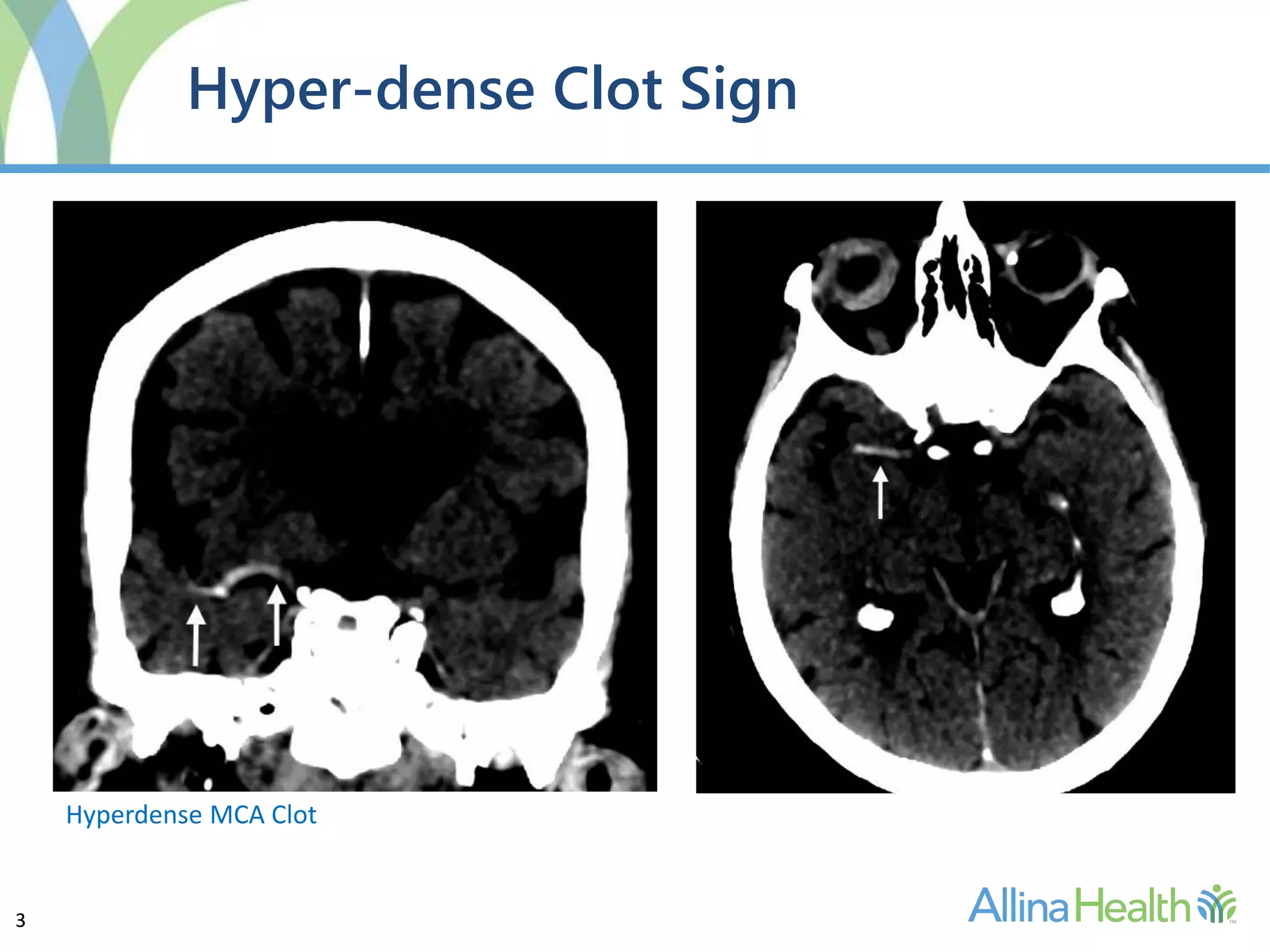 Neurointerventional Treatment of Acute Stroke in 2015 at Abbott ...