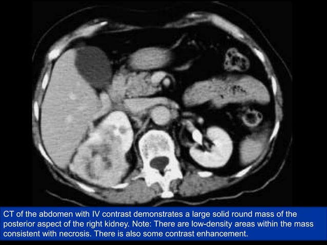 2 abdomen pathology ct | PPTX