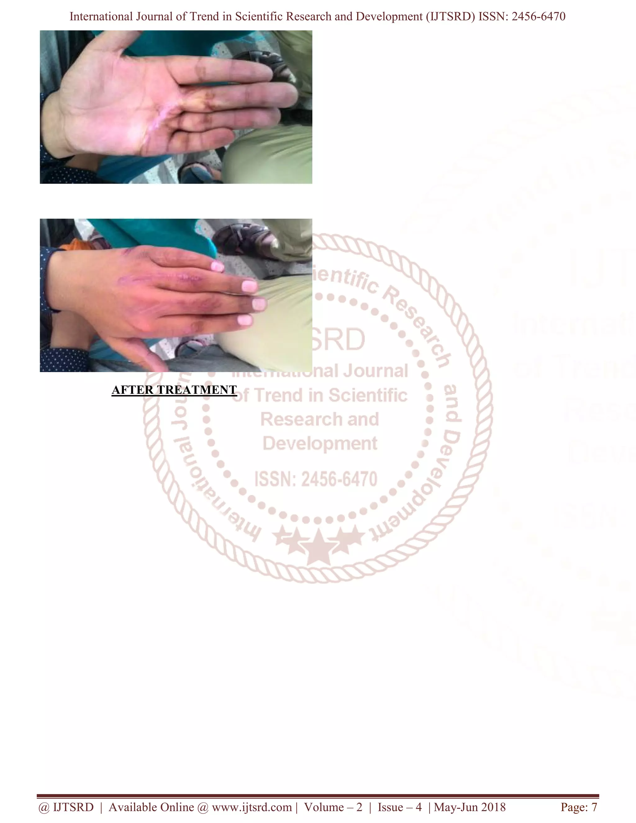 A Case Study of Traumatic Wound Treated with Jatyadi Ghrita | PDF