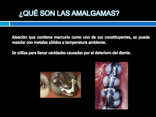 Amalgamas | PPTX