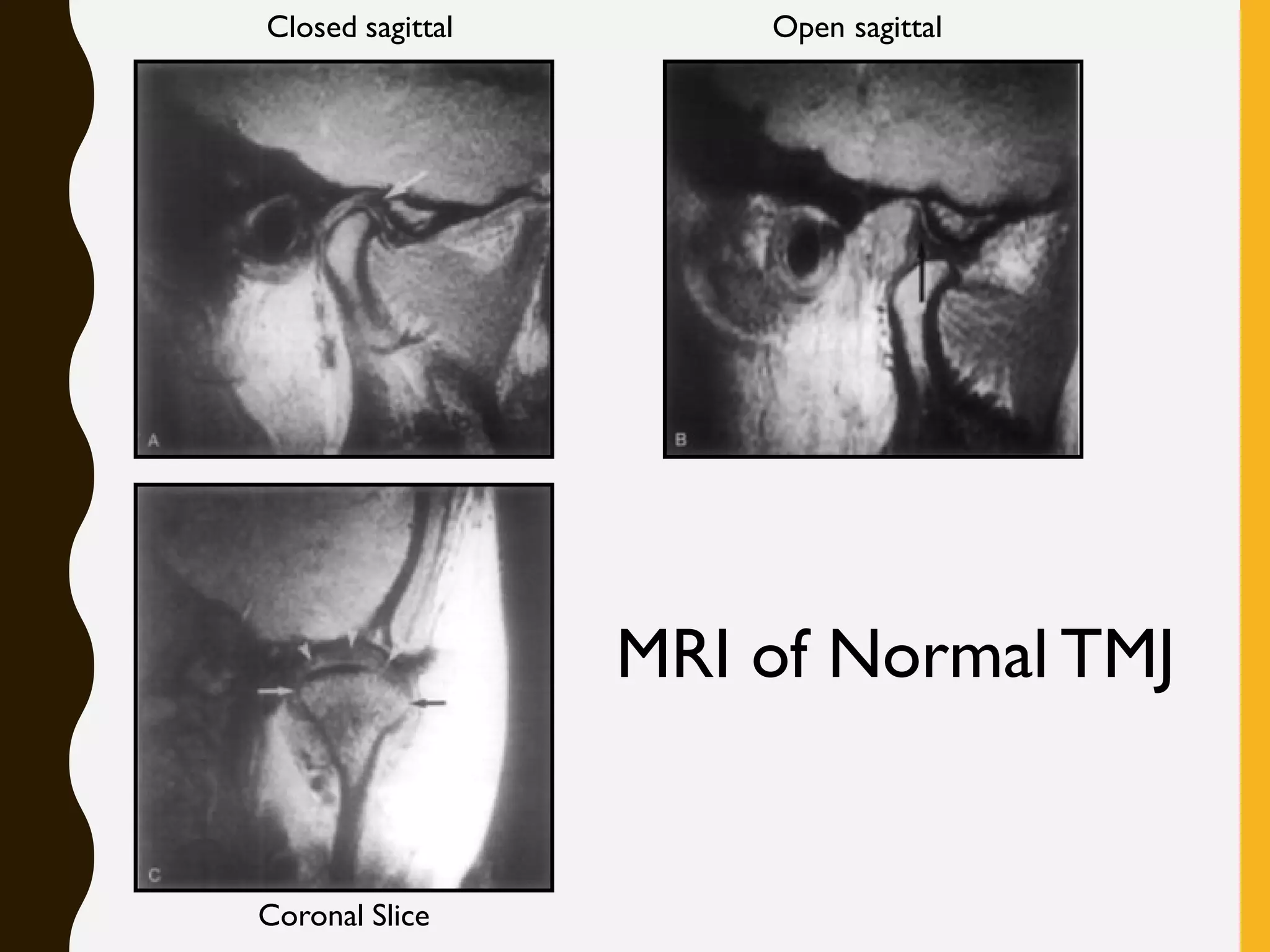 2 anatomy & physiology of tmj2 | PDF