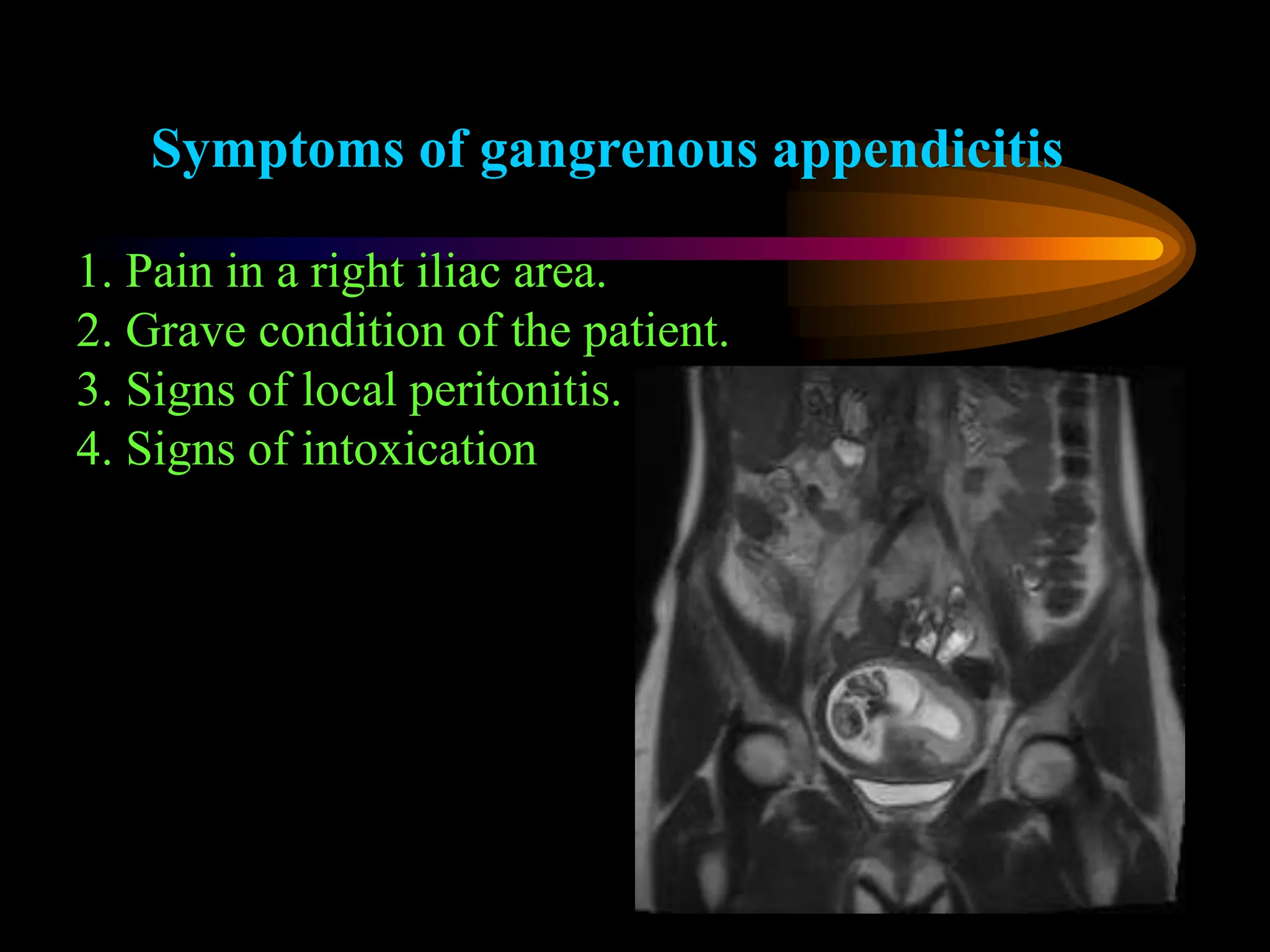 Appendicitis - disease, etiology, treatment | PPT | Digestive Disorders ...