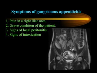 2 Appendicitis . Inflammation of appendix | PPT