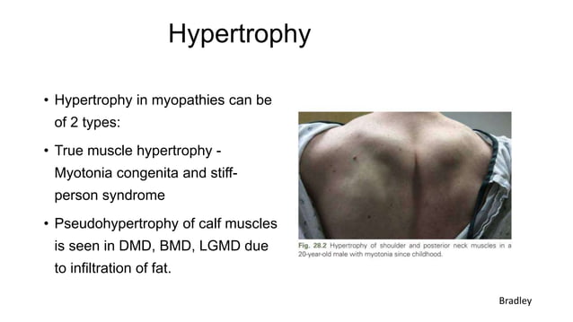 Clinical approach to myopathy and management.pptx