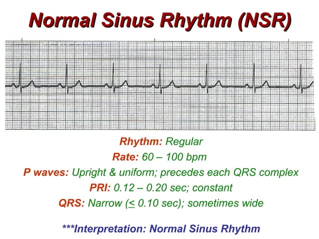 Sinus Rhythms - BMH/Tele | PPT | Heart and Cardiovascular Diseases ...