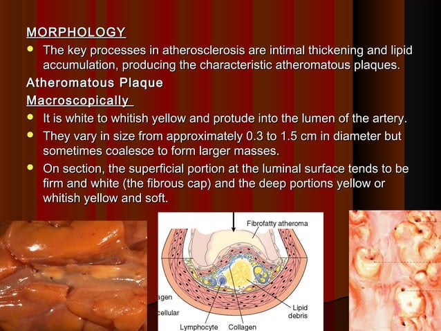 2 atherosclerosis pathology | PPT