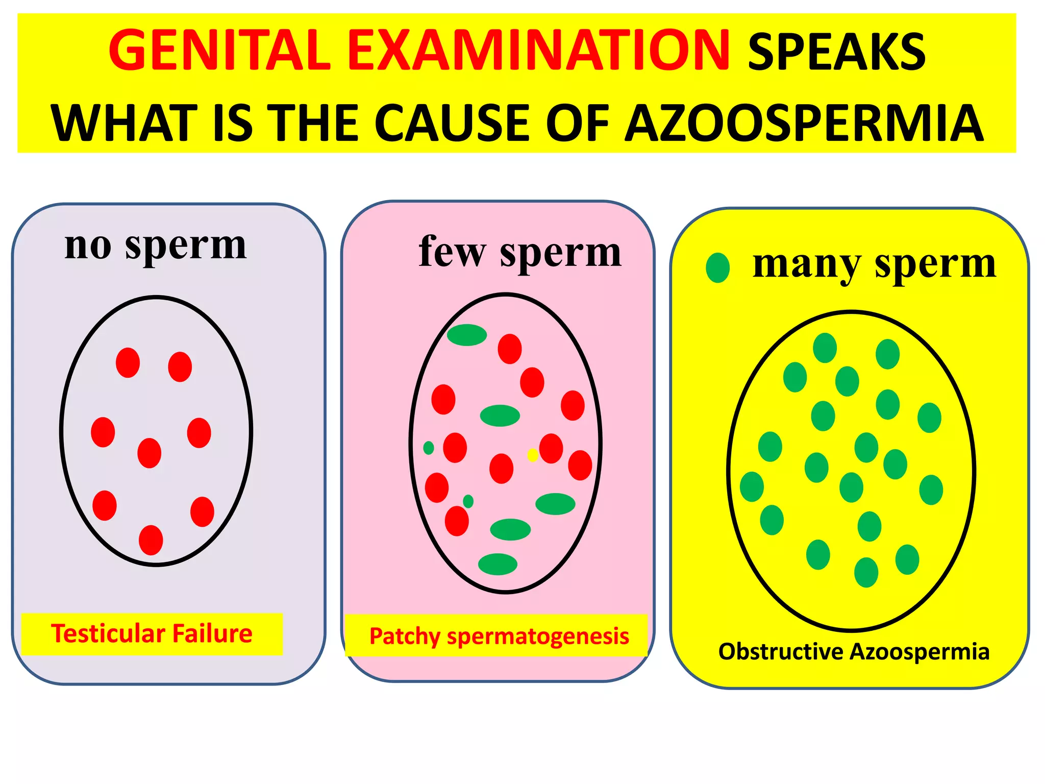 AZOOSPERMIA Management Made Simple : “Stepwise approach” | PPTX