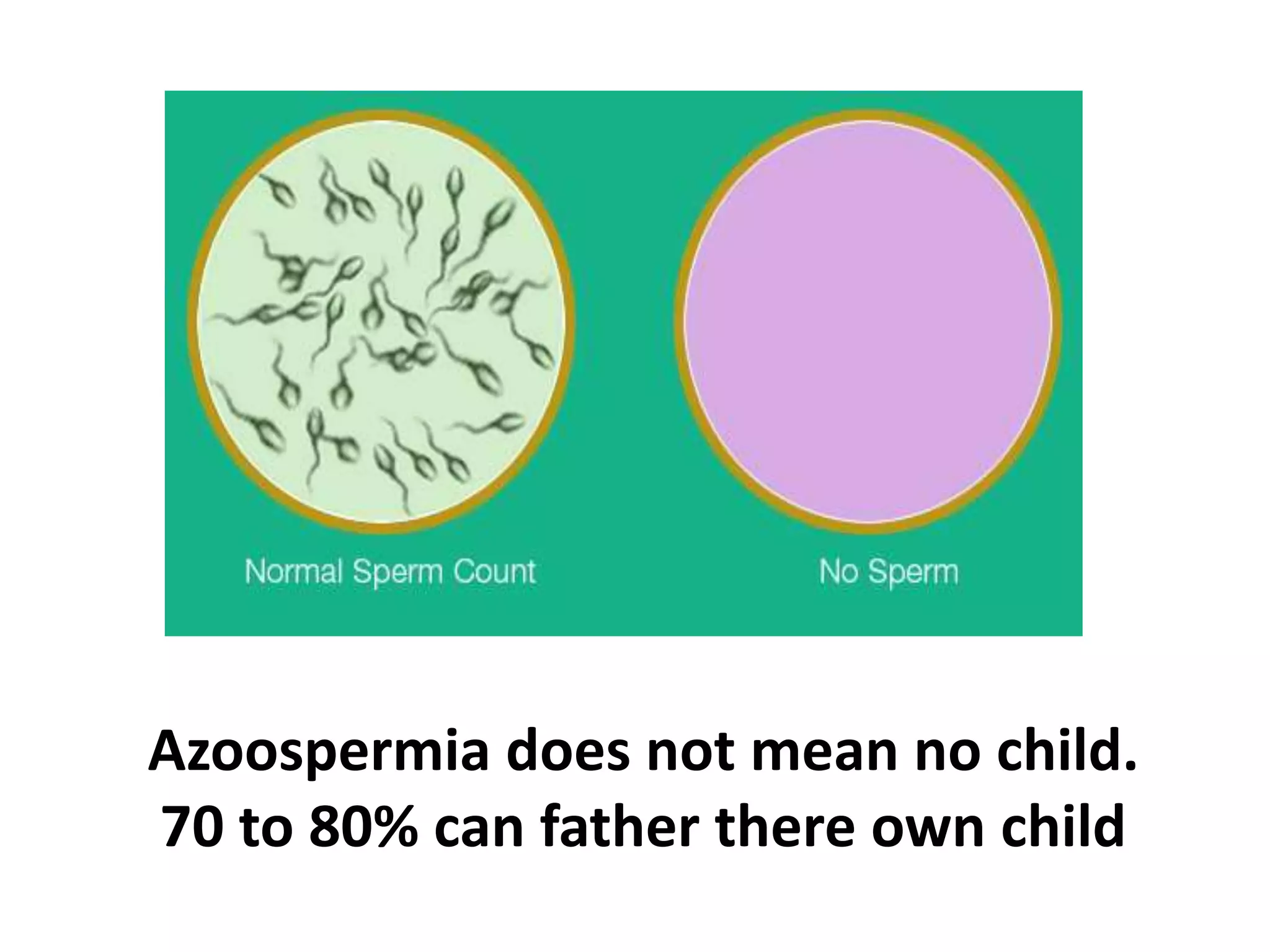 AZOOSPERMIA Management Made Simple : “Stepwise approach” | PPTX