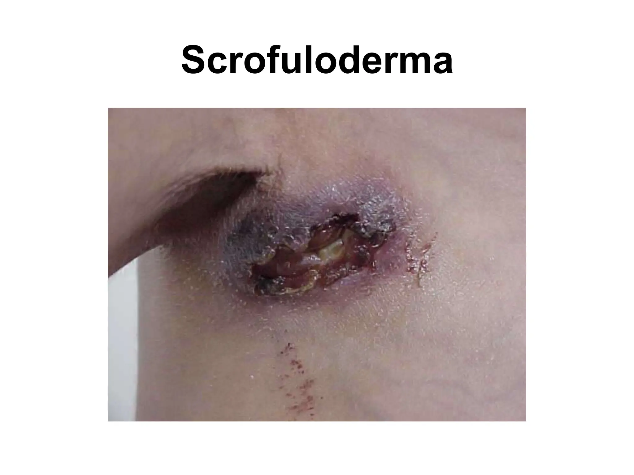 Bacterial skin infections.pptx