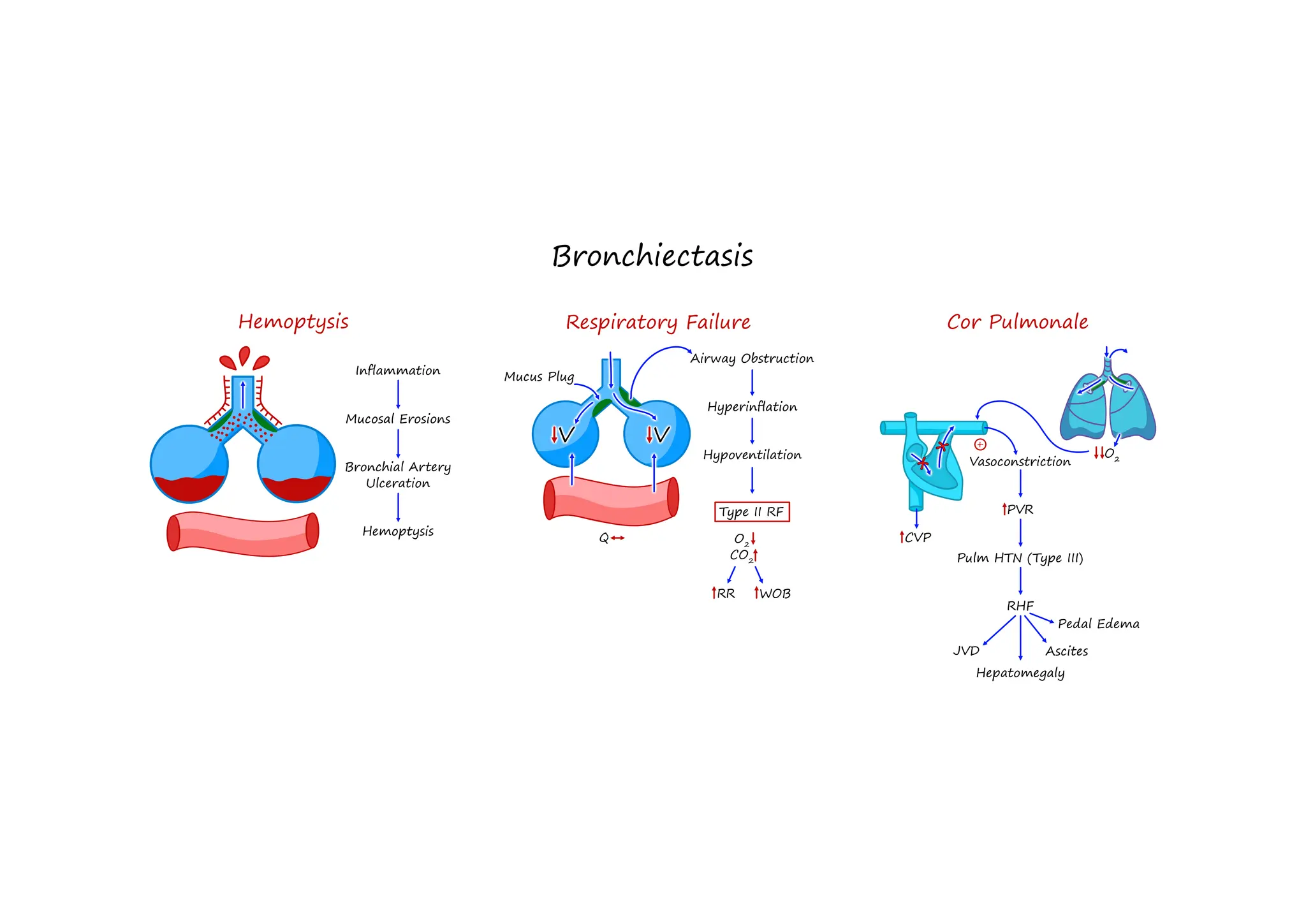 2• Bronchiectasis [Illustrations Key].pdf