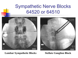 Spinal_Injections_v2_LinkedIN | PPT
