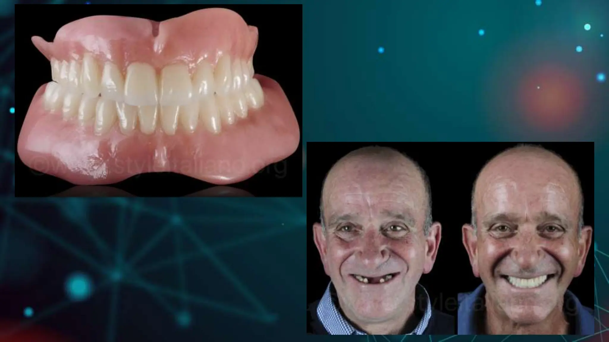 CAD CAM DENTURES IN PROSTHODONTICS : Dental advancements | PPTX