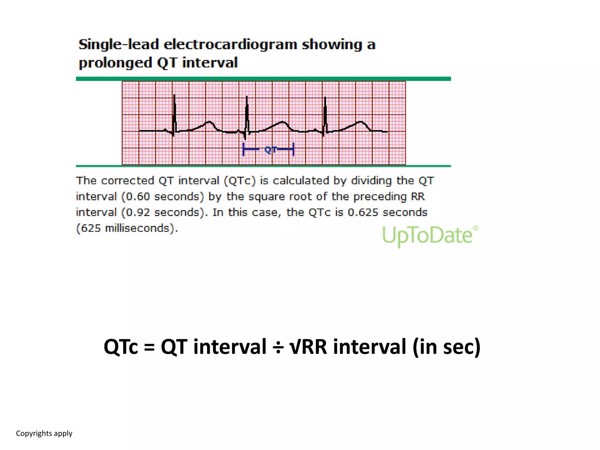 qt syndrome | PPTX