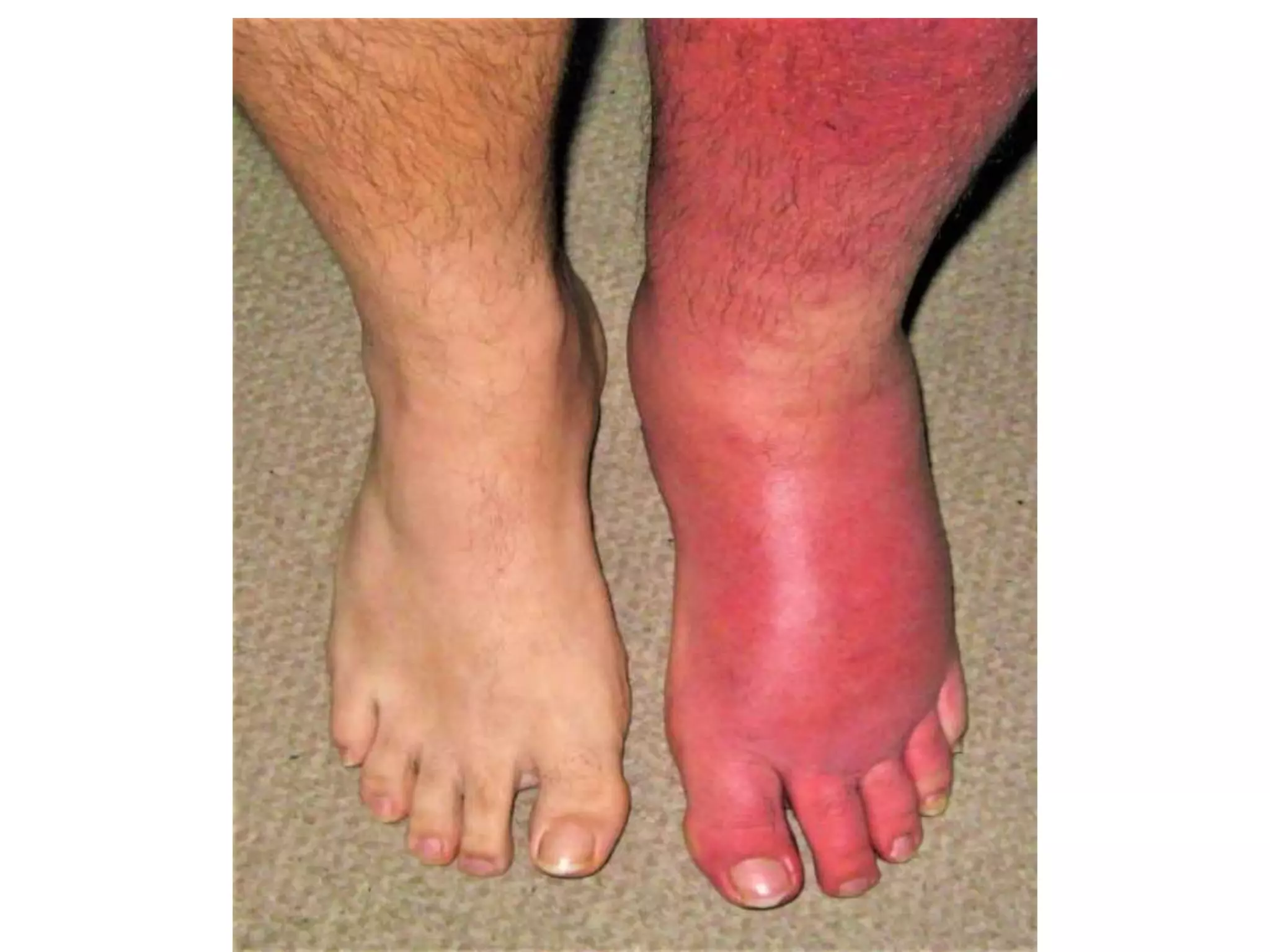 2) CELLULITIS.pptx