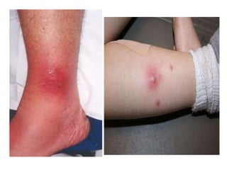 2) CELLULITIS.pptx