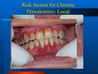 (2)_Chronic_Periodontitis in periodontology | PPT