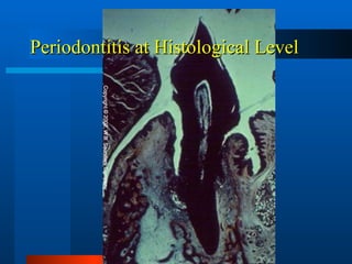(2)_Chronic_Periodontitis in periodontology | PPT