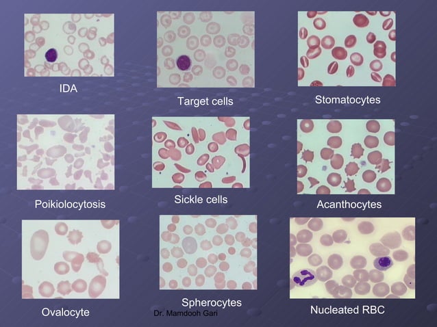 2 classification of anemia | PPT | Blood Disorders | Diseases and ...