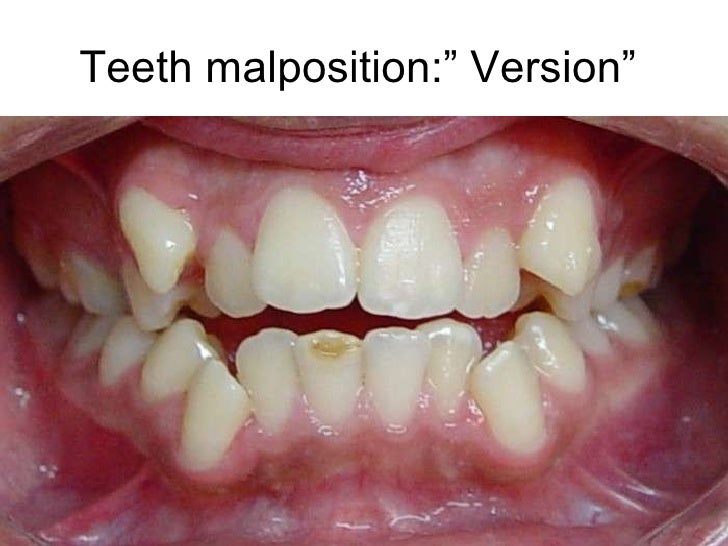 classification of malocclusion