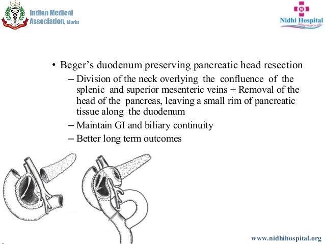 Surgical Management of Chronic Pancreatitis