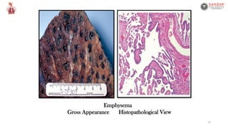 Chronic Obstructive Pulmonary Disease... | PDF