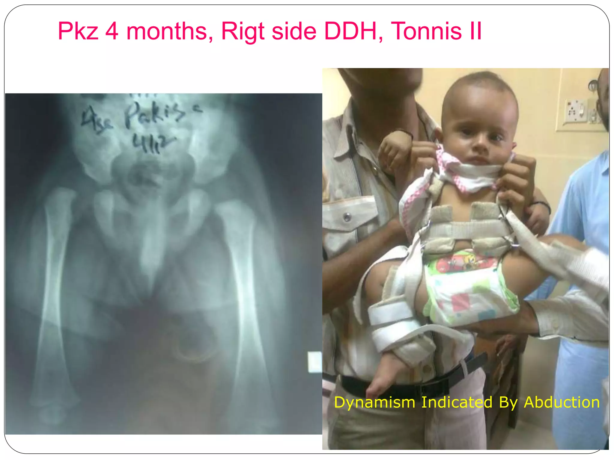 2 ddh principles & protocols of rx. 0 12 m age | PPT