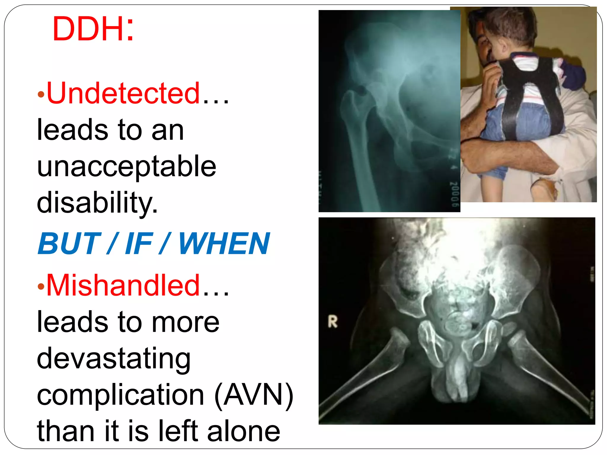 2 ddh principles & protocols of rx. 0 12 m age | PPT