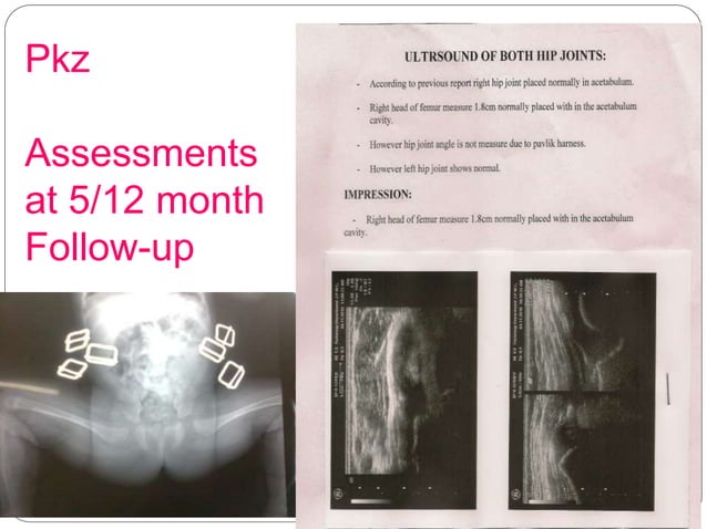 2 ddh principles & protocols of rx. 0 12 m age | PPT