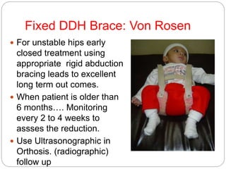 2 ddh principles & protocols of rx. 0 12 m age | PPT