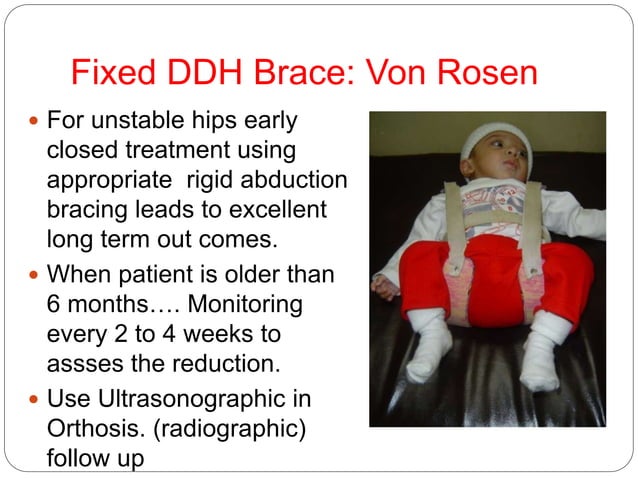 2 ddh principles & protocols of rx. 0 12 m age | PPT