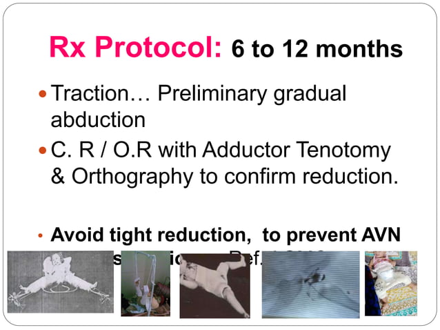 2 ddh principles & protocols of rx. 0 12 m age | PPT