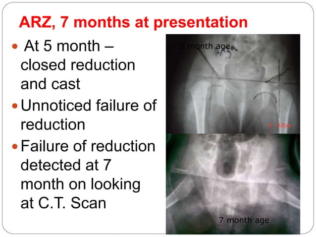 2 ddh principles & protocols of rx. 0 12 m age | PPT